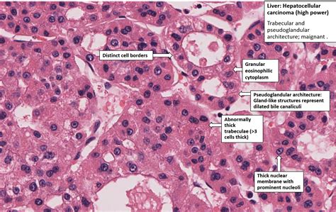 Liver Hepatocellular Carcinoma NUS Pathweb NUS Pathweb