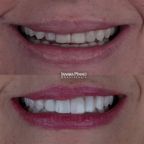 Lente De Contato Dental Antes E Depois Ianara Pinho Odontologia