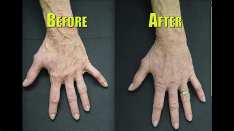 Hand Veins Popping Out