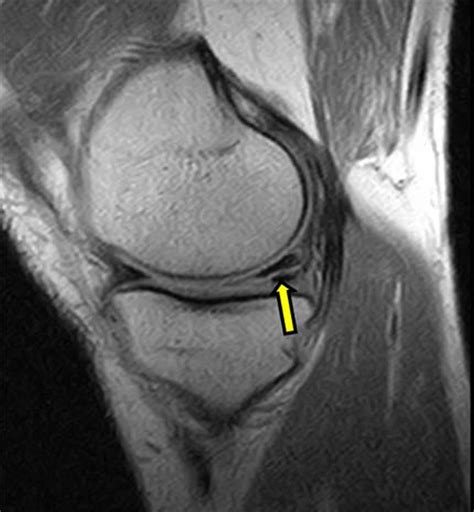 How To Read Knee Mri Knee Mri Mri Scan Meniscus Tear Images And