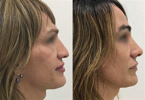 Facial feminization surgery before and after Facifem Dr Macía patients