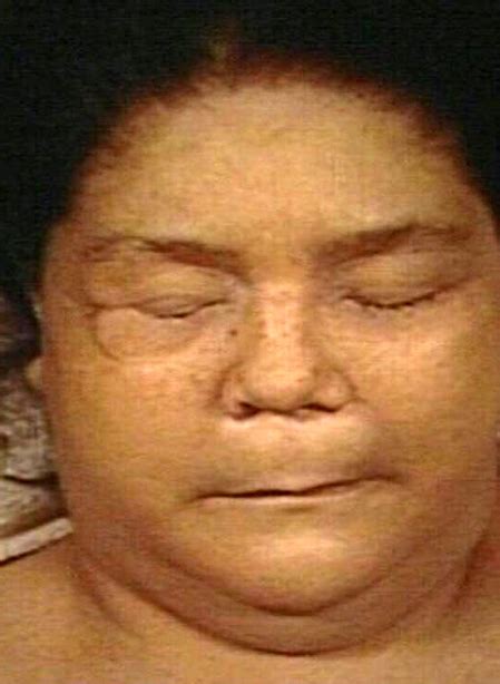 Myxedema Medlibes Online Medical Library