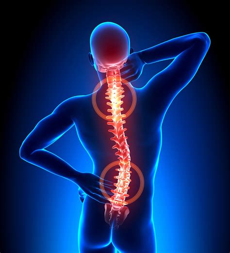LA PREVENCIÓN MEJOR TRATAMIENTO PARA LA FRACTURA VERTEBRAL