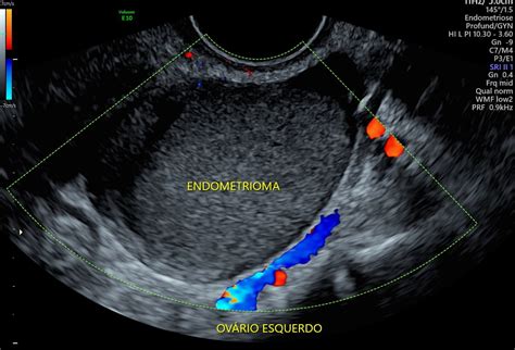 Qual O Exame Para Detectar A Endometriose Dra D Bora Andrade
