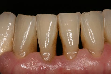 Periodontitis