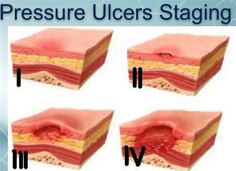 Pressure Ulcer Staging Https Woundtx Woundtx Pressure