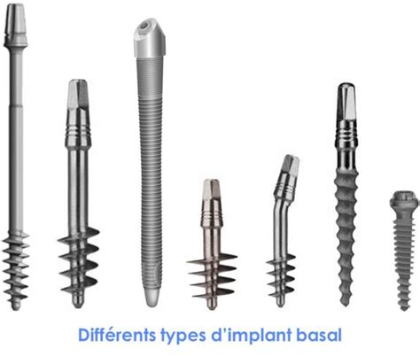 Implant Basal Techniques D Implantologie Basale La Solution Pour Vous