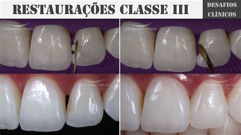 Restaurações classe III Desafios clínicos YouTube