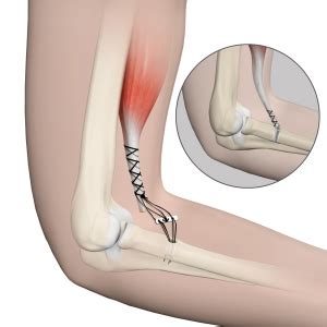 Distal Biceps Repair Advanced Orthopaedics Sports Medicine