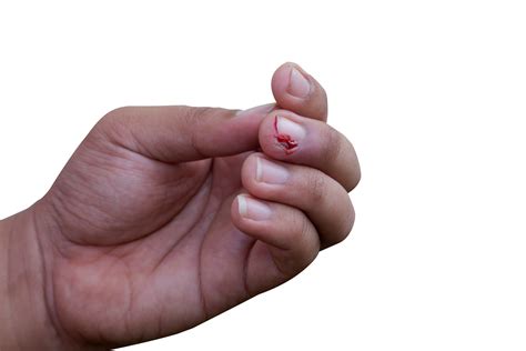 selektiv fokus på blödning fingrar på grund av till ingrown spikar i