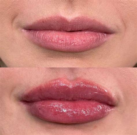 Lip Filler Archives Skinfitokc