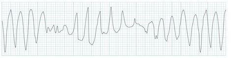Polymorphic Ventricular Tachycardia Ecg