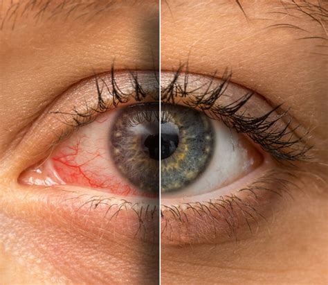 Red Eyes Blurred Vision Ultimate Guide Best Treatments Real Eyes
