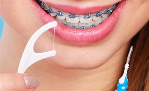 Você sabe usar fio dental aparelho Veja 3 dicas