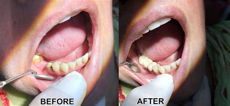 Replacing Missing Teeth Oberoi Dental Clinic