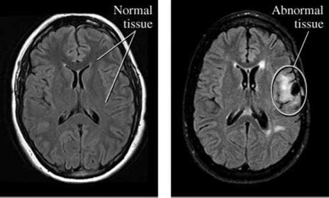 Exemple D Irm De Cerveau Humain Normal Et Anormal D Apr S
