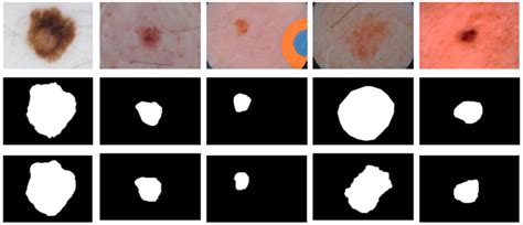 deep learning for skin lesion segmentation joshua ebenezer