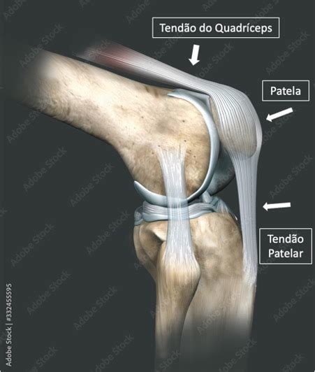Tratamento Das Fraturas Da Patela Dr Leonardo Rocha Thomaz