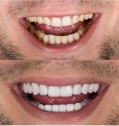 Lentes De Contato Dental Entenda Para Que Servem E O Que Fazer Para