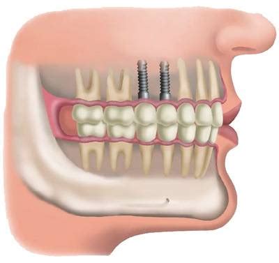 Implantes dentales en Valencia Clínica Dental Almar