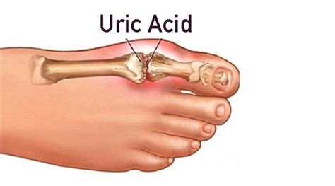 Home Uric Acid Level Tests