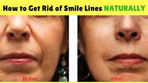 HOW TO GET RID OF SMILE LINES NATURALLY IN A WEEK 100