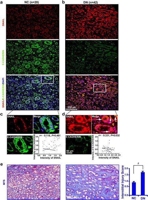 SNAIL Negatively Correlates With E CADHERIN And Corresponded With