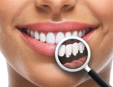 Din Ce Sunt Facute Implanturile Dentare