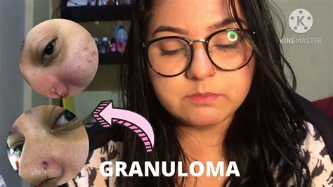 Queloide Granuloma Ou Bolinha No Piercing No Meu Piencirg Do Nariz