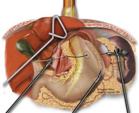 Hiatal Hernia Repair Laparoscopic