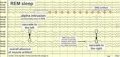 Rapid Eye Movement REM Sleep