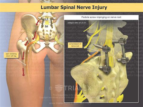 Lumbar Spinal Nerve Injury TrialQuest Inc