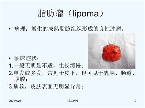 脂肪瘤会变成脂肪肉瘤吗良性和恶性之分 发病 胆固醇 饮食