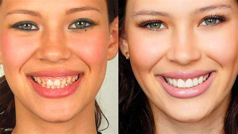 Lente de contato dental veja como é feito o sorriso dos artistas