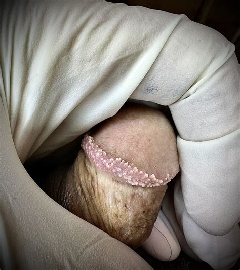 Pápulas perladas Granitos blancos en el pene