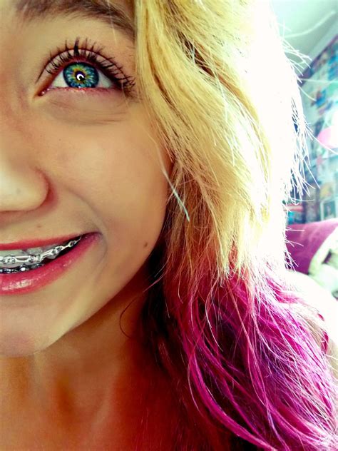 Girls With Braces On Twitter Loving This Colorful Picture Braces Kagrcs6jwr