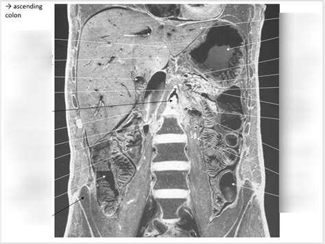 Coronal Abdomen Diagram Quizlet