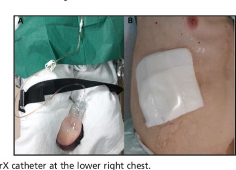Pleurx Catheter