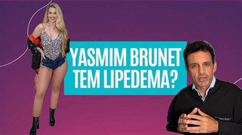 BBB 24 Yasmin Brunet Tem Lipedema Saiba o que é a doença Dr