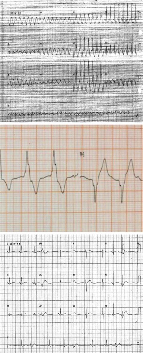 Monomorphic Ventricular Tachycardia