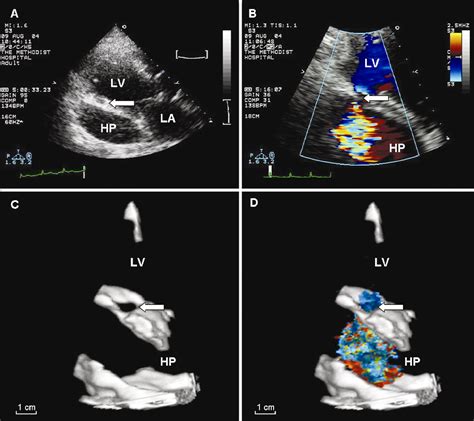 Real Time 3 Dimensional Echocardiography Demonstrates Size And Extent