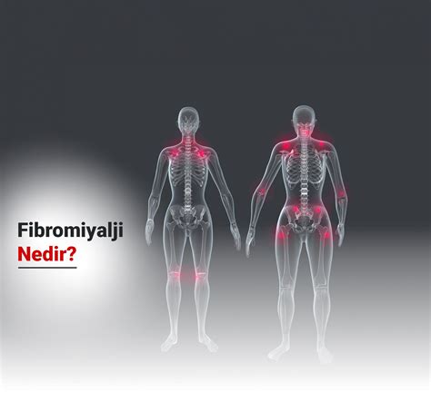 Fibromiyalji Nedir Belirtileri Nelerdir Tedavi Yöntemleri Nelerdir