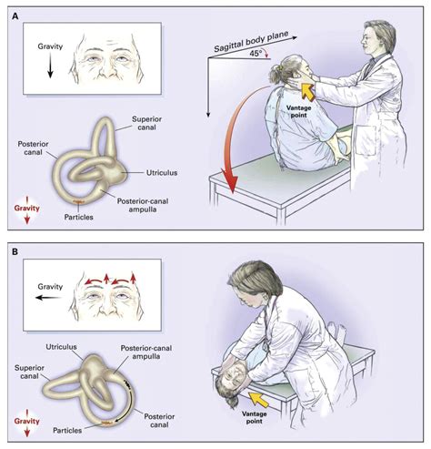 Epley Maneuver Illustration