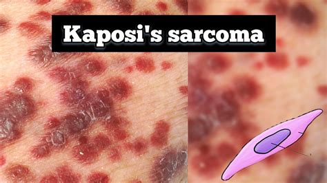 Kaposi S Sarcoma Pathology Kaposi S Sarcoma Lecture Quick Revision