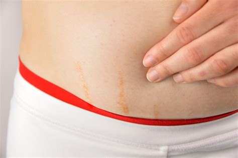 Cuidados a cicatriz da abdominoplastia Clínica Clincer