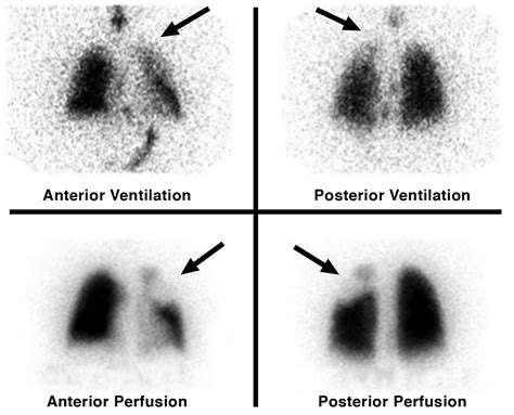 Overview Of The Novel And Improved Pulmonary Ventilation Perfusion
