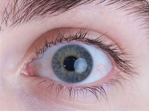 Grey Eye Gray Eyes Central Heterochromia Heterochromia