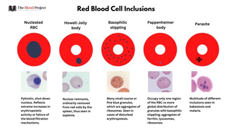 Red Cell Inclusions The Blood Project