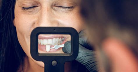 Teeth Veneers Pros And Cons Of This Dental Treatment 2024