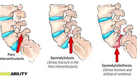 Types Of Lumbar Fractures Design Talk
